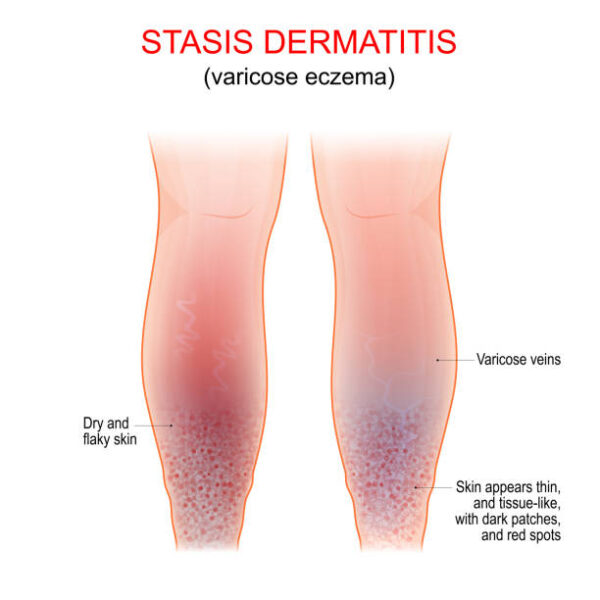 Venous Stasis Dermatitis: Understanding, Causes, and Treatment