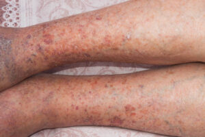 Venous Stasis Dermatitis: Understanding, Causes, and Treatment